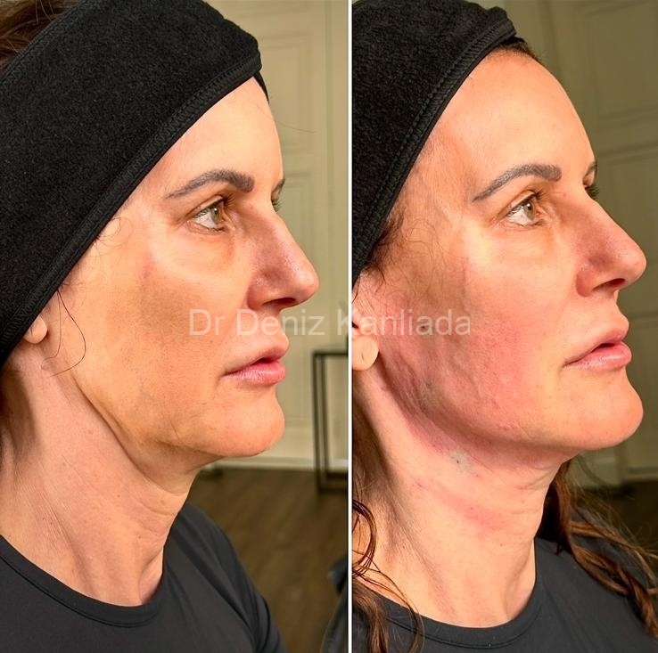 Endolift London | Non-Surgical Facelift & Neck Lift | Dr Deniz Kanliada